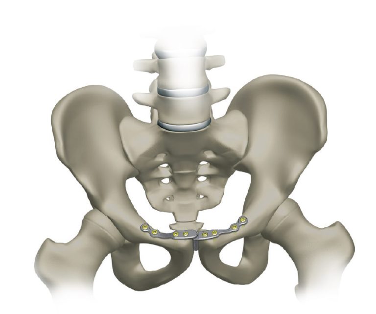 Pelvis Fixation – Novutech